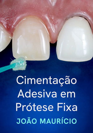 Assista online: Cimentação Adesiva em Prótese Fixa | Ident
